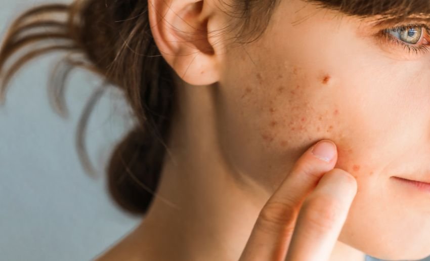 Boutons sur le visage : causes et solutions